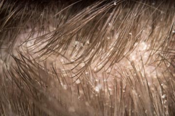 Quick Tips: Dandruff Remedies | HowStuffWorks