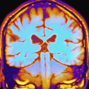 Amnesia Detection and Prevention | HowStuffWorks